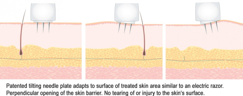 MTS Microneedling – Nu U Skinlab